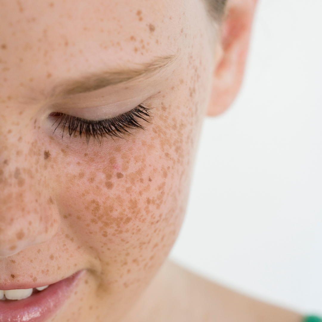 The Secrets of Dark Spots And How To Prevent Them - Viriditas Beauty