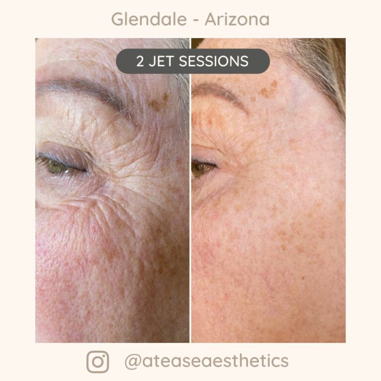 Jet Plasma Pen - Viriditas Beauty